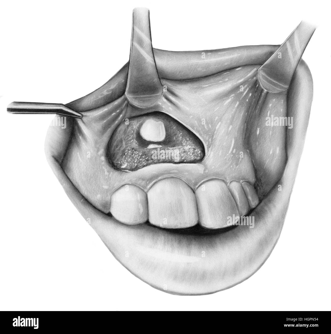 Teeth - Surgical Exposure of Impacted Tooth Stock Photo - Alamy