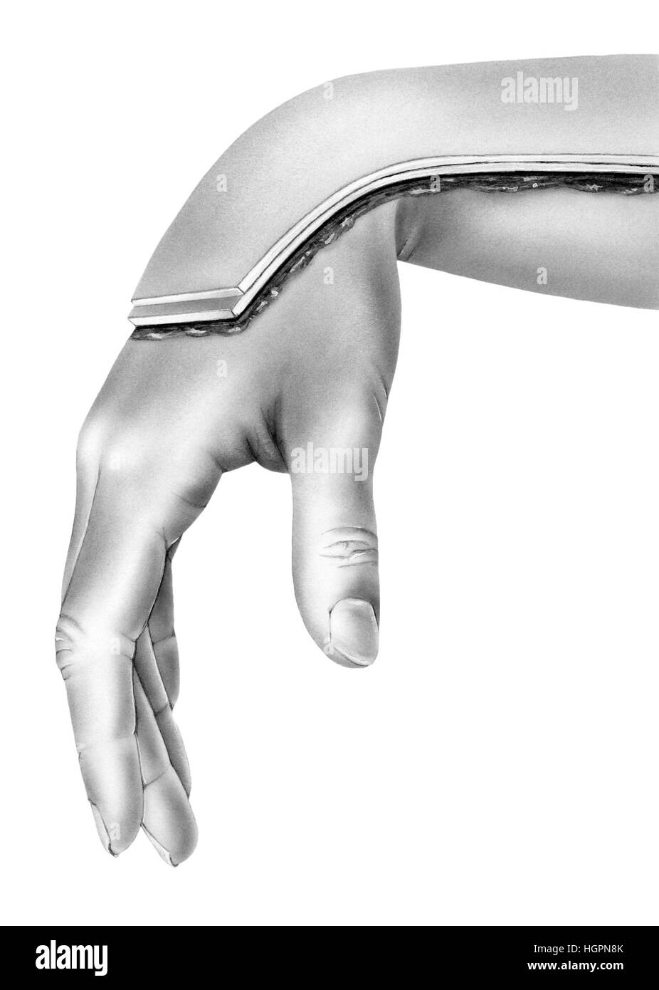 Wrist - Burn Dressing. Healing burns on the back of a human hand and ...