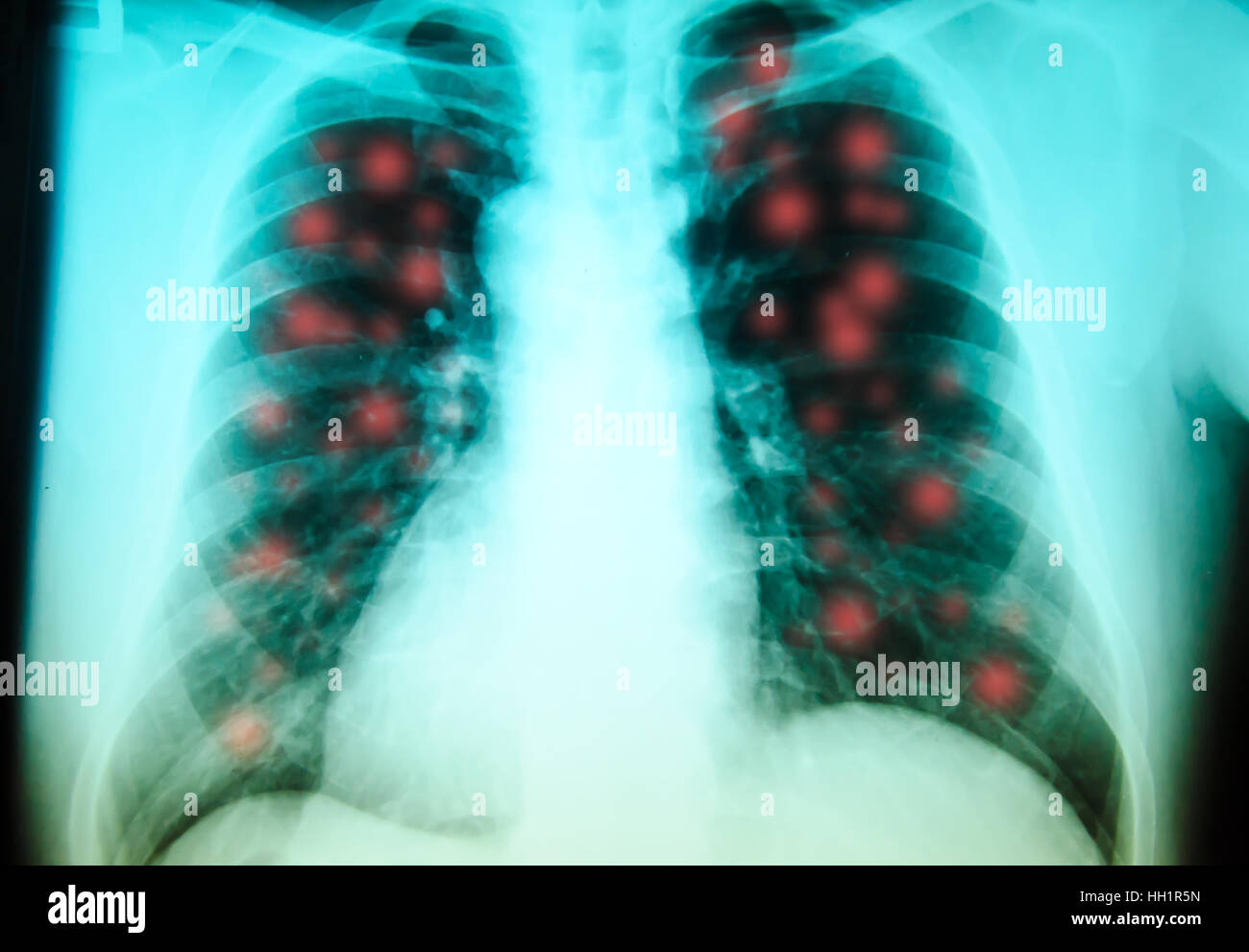 chest x-ray for diagnosis in hospital with inflamation Stock Photo - Alamy