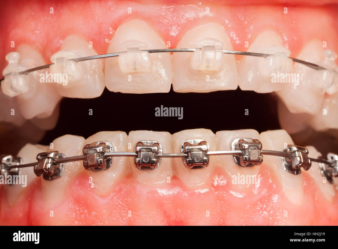 Braces mouth open hi-res stock photography and images - Alamy