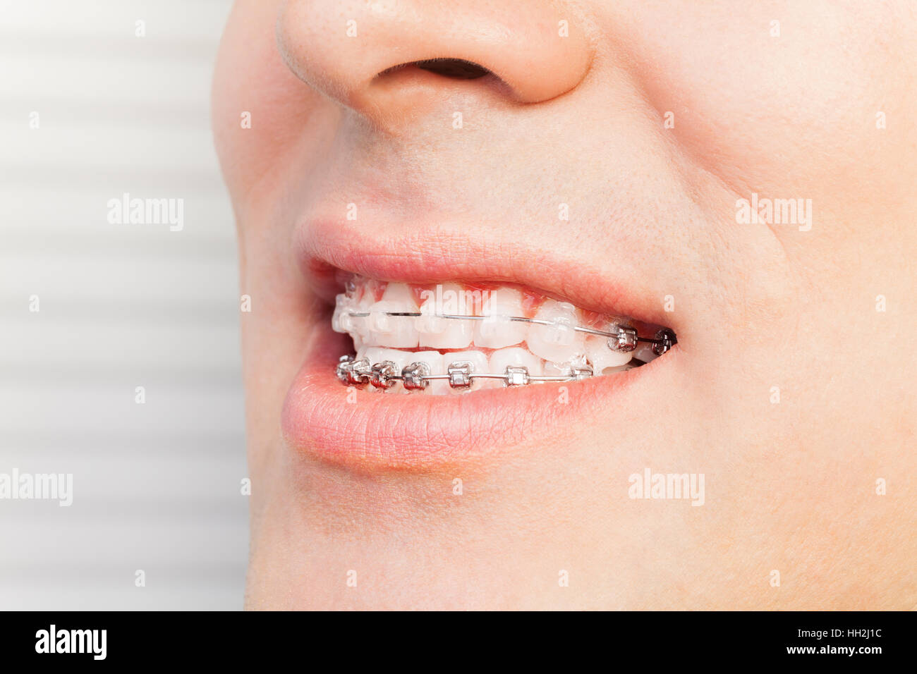Braces on teeth hi-res stock photography and images - Alamy