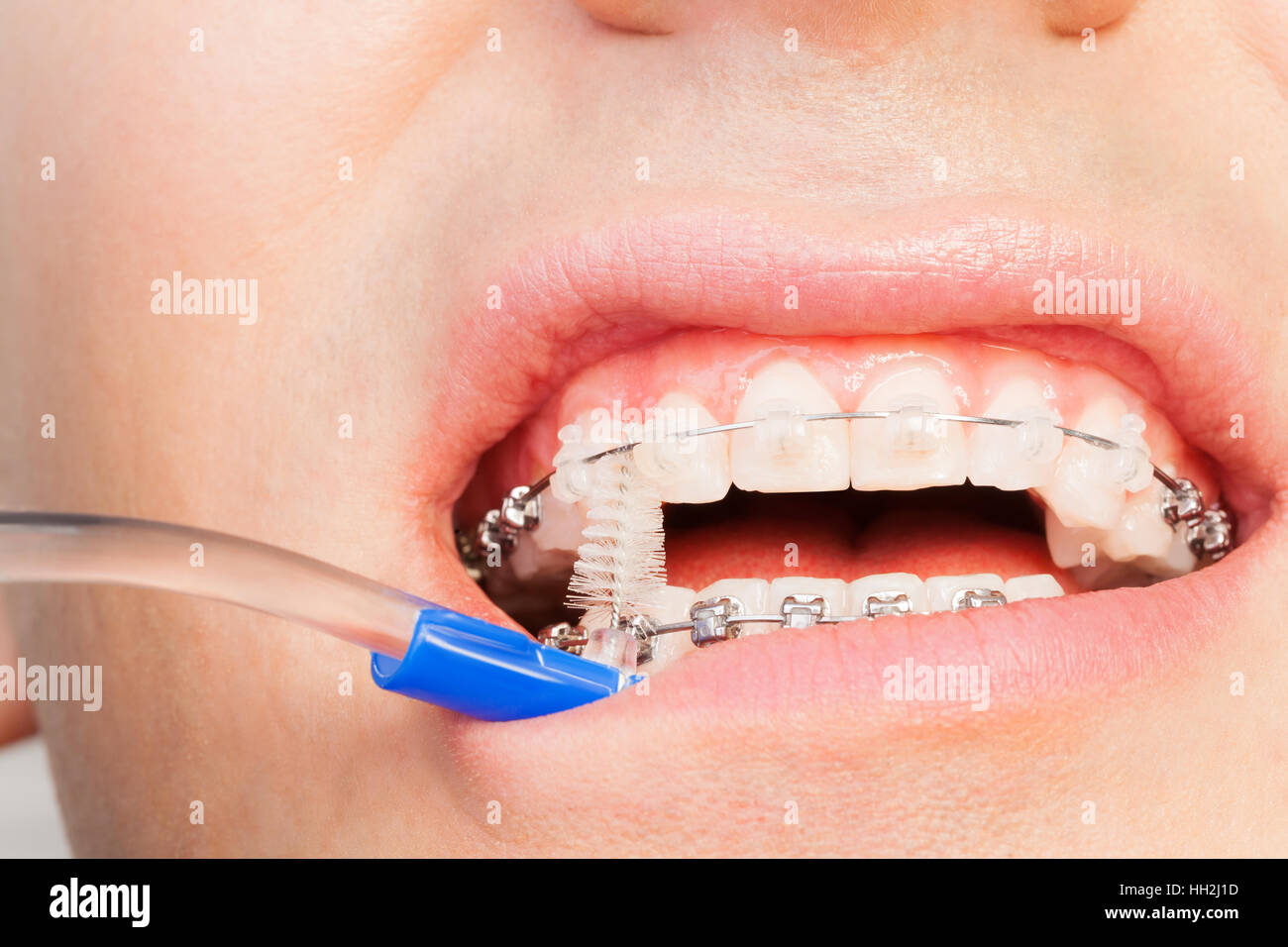 Man cleaning his teeth brace by brush Stock Photo - Alamy