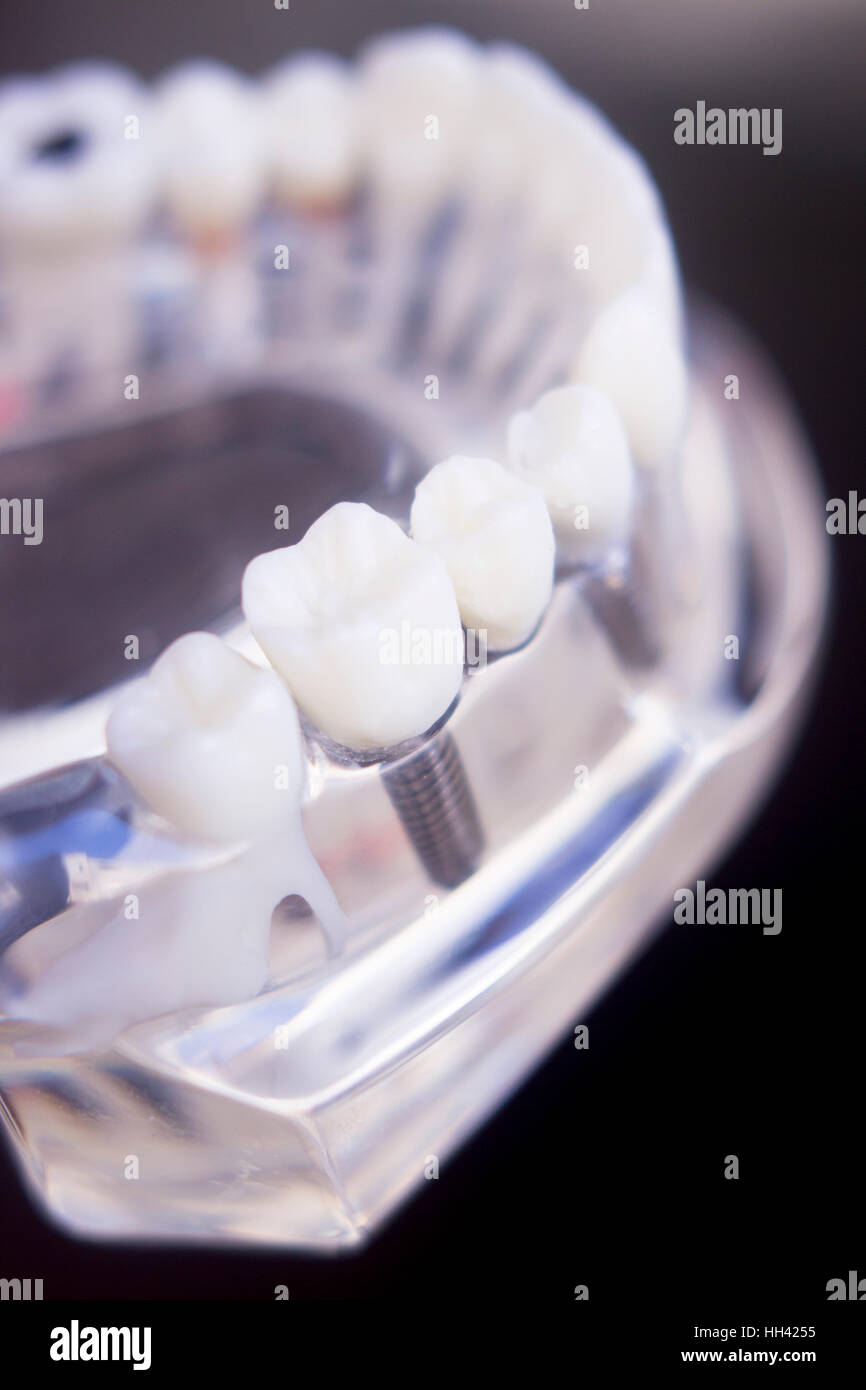 Dentists tooth plastic model used for teaching, learning and patient ...