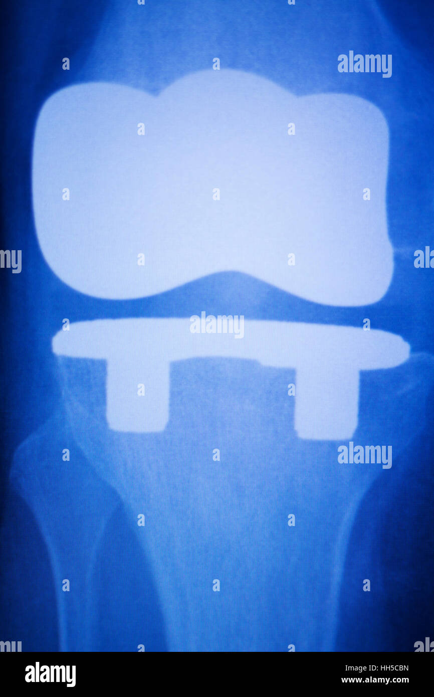 Knee joint implant replacement xray showing in medical orthpodedic ...