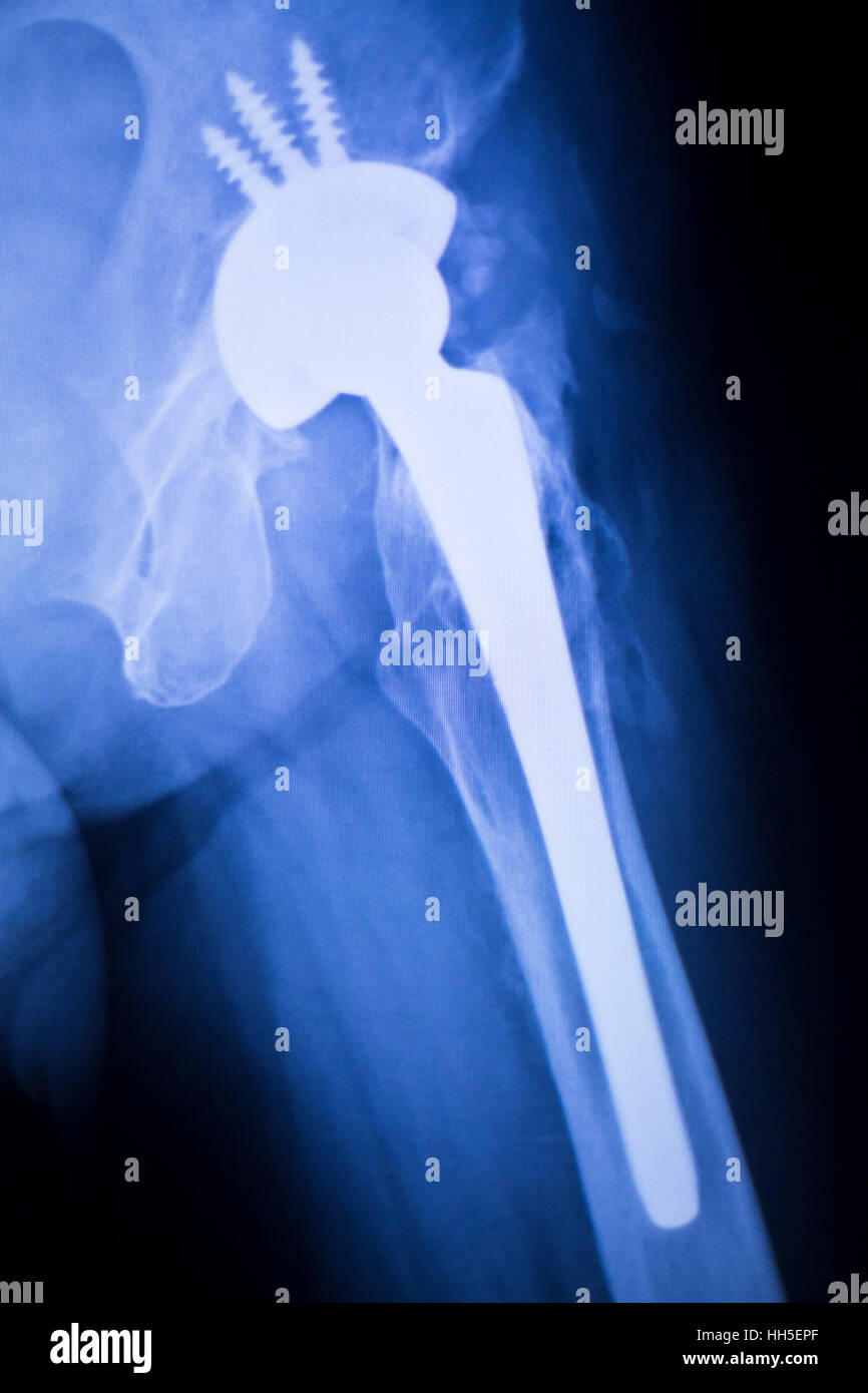 Hip Ball And Socket High Resolution Stock Photography and Images - Alamy