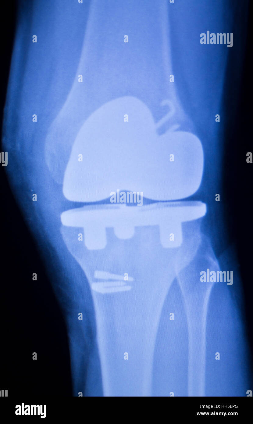 Knee joint implant replacement xray showing in medical orthpodedic ...