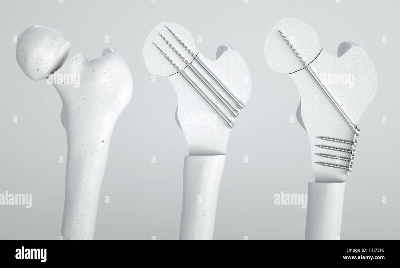Fracture of the femur - Treatment with screws - 3D Rendering Stock ...