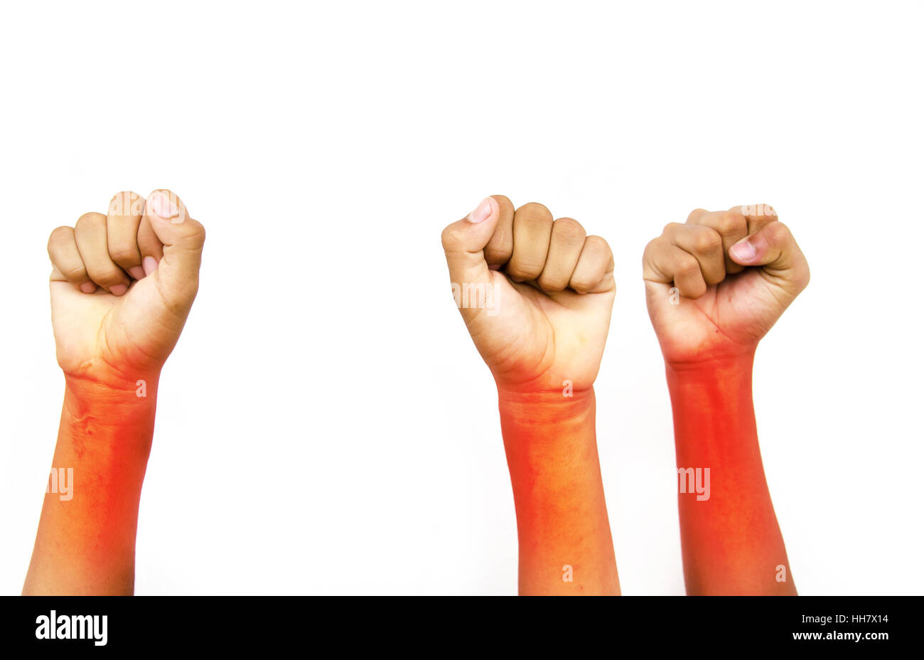 injury hand from children for victory on white background Stock Photo ...