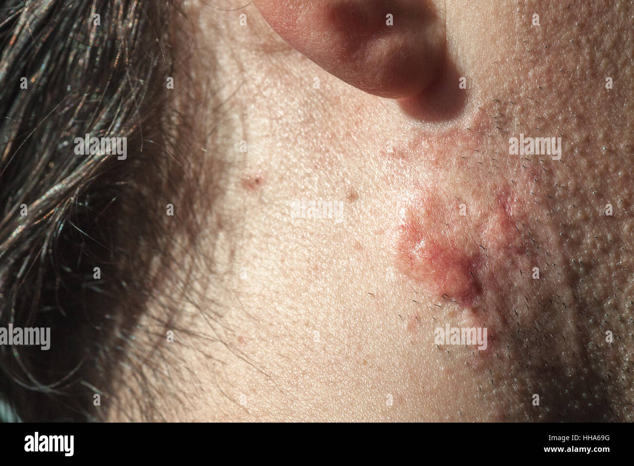 Skin cancer close up on man cheek Stock Photo - Alamy Skin cancer close up on man cheek Stock Photo - Alamy