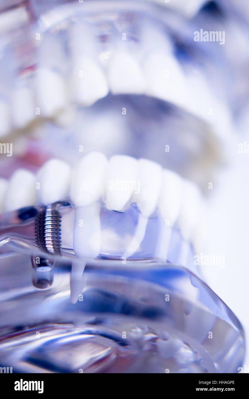 Dentists tooth plastic model with screw implant for teaching, learning ...