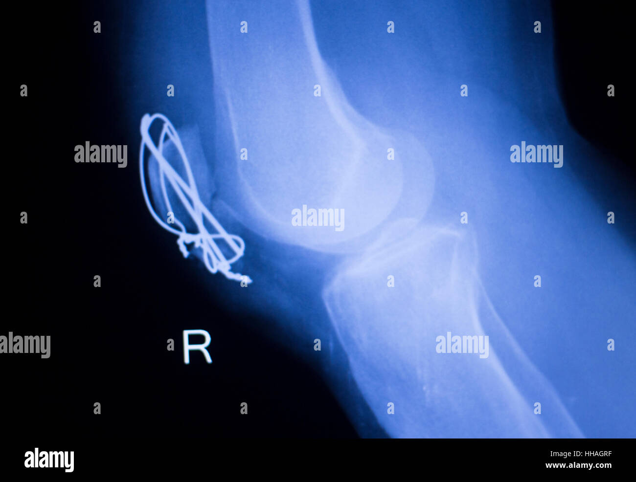 Artificial knee xray hi-res stock photography and images - Alamy