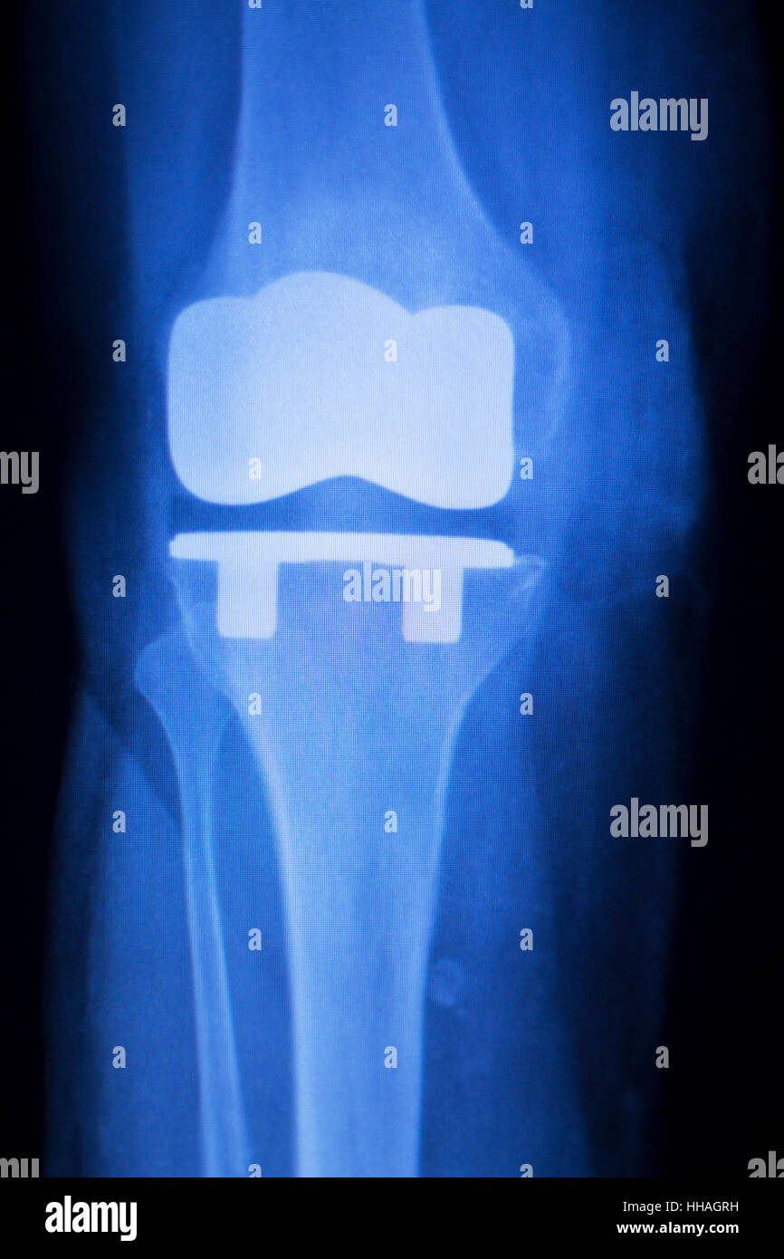 Knee Replacement Xray High Resolution Stock Photography and Images - Alamy