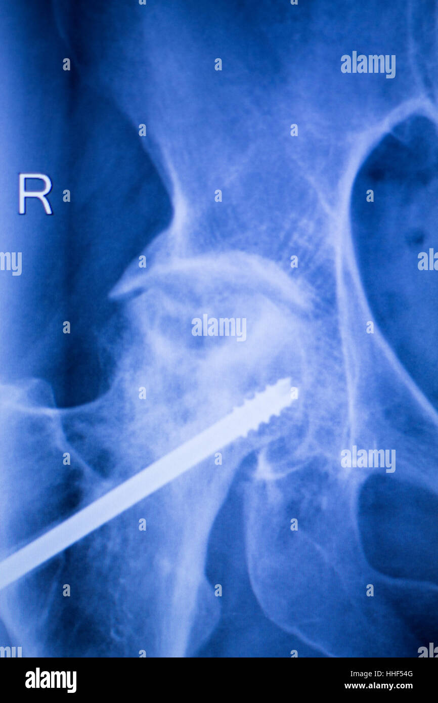 Ball socket joint anatomy hi-res stock photography and images - Alamy