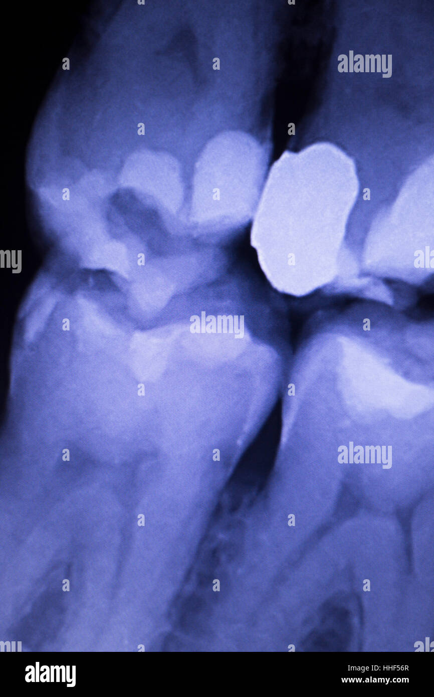 Tooth with filling dental x-ray close-up image showing teeth roots, gum ...