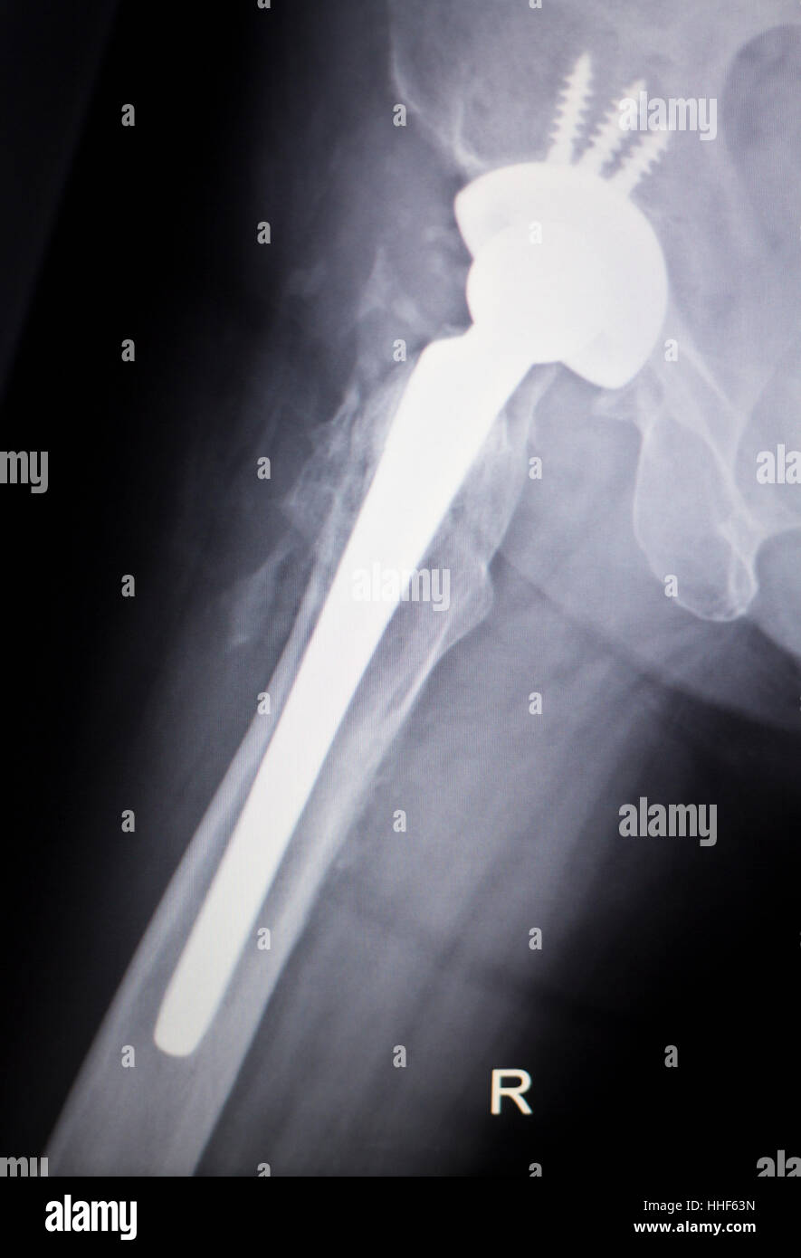 Ball socket joint anatomy hi-res stock photography and images - Alamy