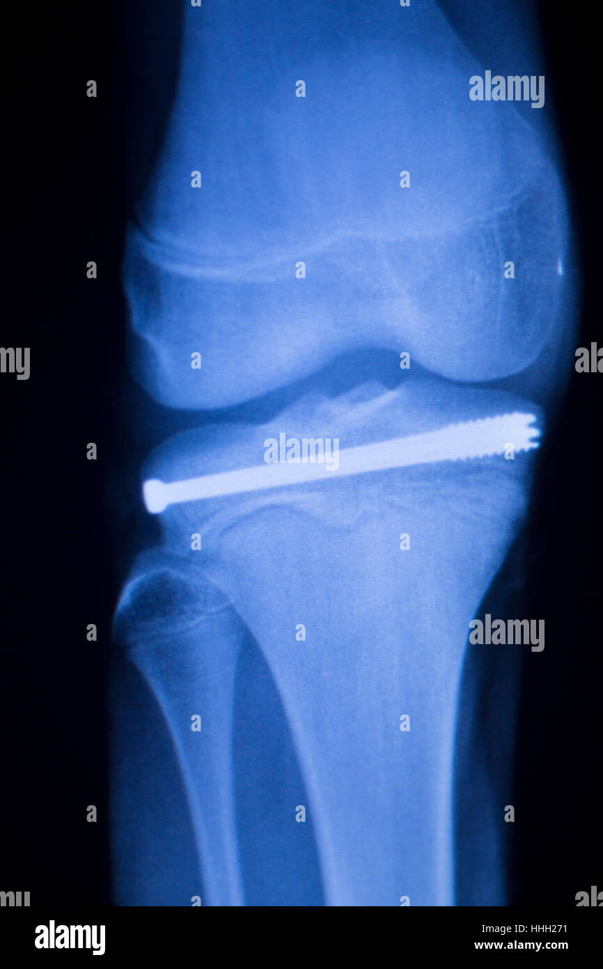 Artificial knee xray hi-res stock photography and images - Alamy