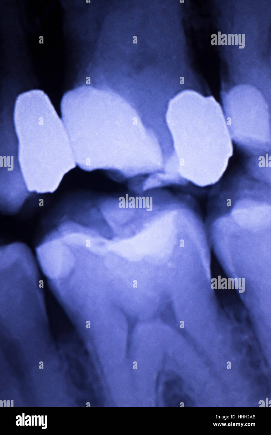 Human skull showing roots of teeth hi-res stock photography and images ...