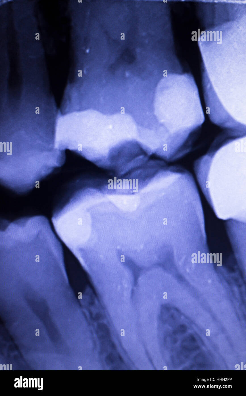 Human skull showing roots of teeth hi-res stock photography and images ...