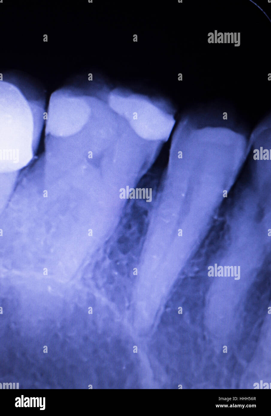Tooth with filling dental x-ray close-up image showing teeth roots, gum ...