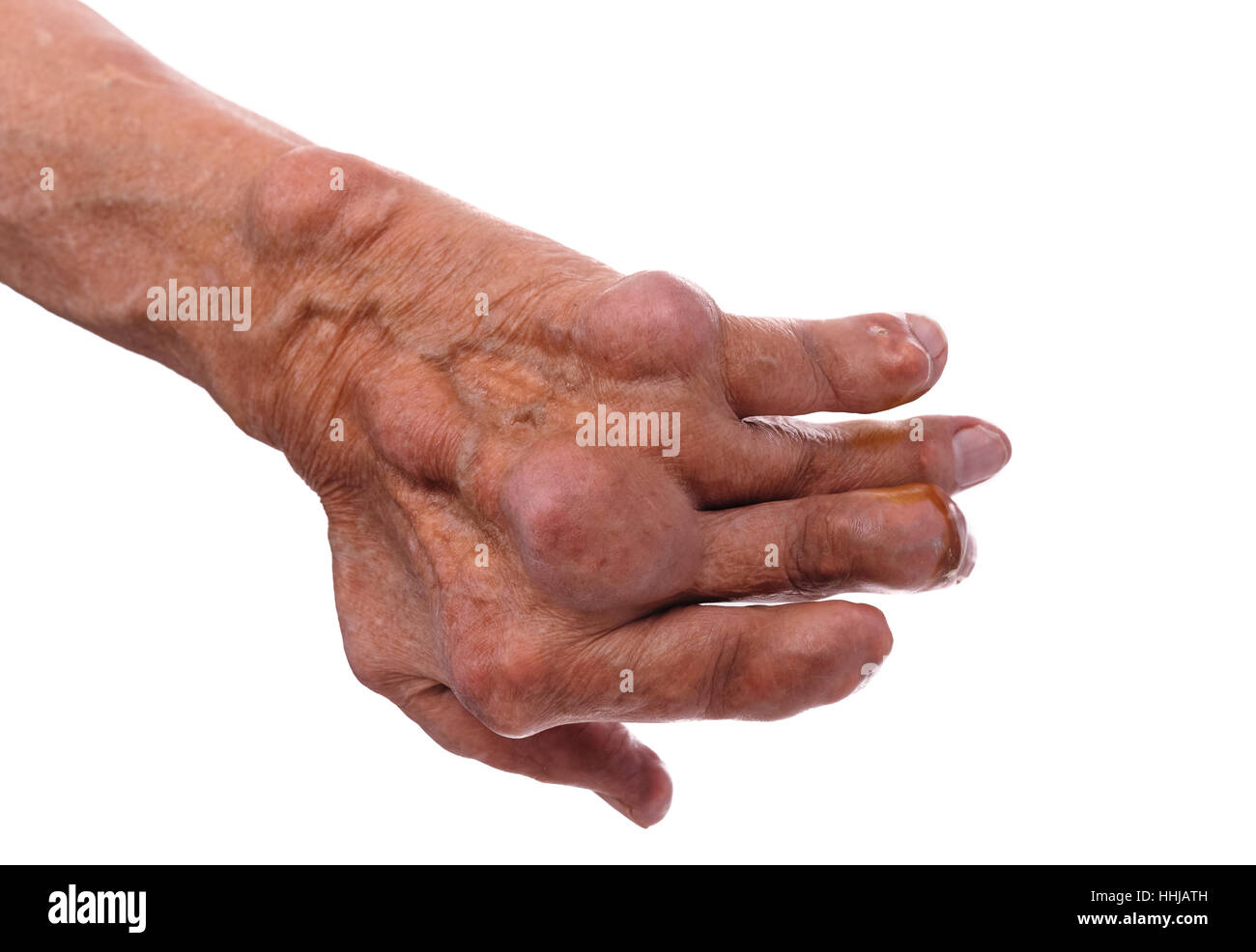 A man with a diagnosis of polyarthritis (severe stage) . The local ...