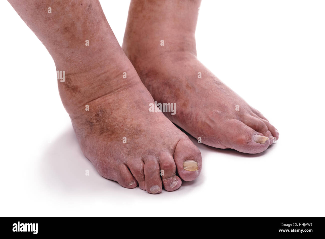Polyarthritis High Resolution Stock Photography and Images - Alamy
