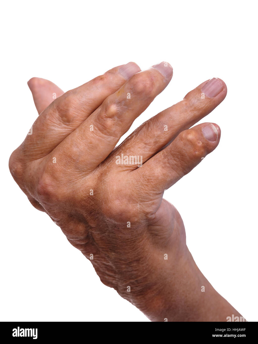 A man with a diagnosis of polyarthritis (severe stage) . The local ...