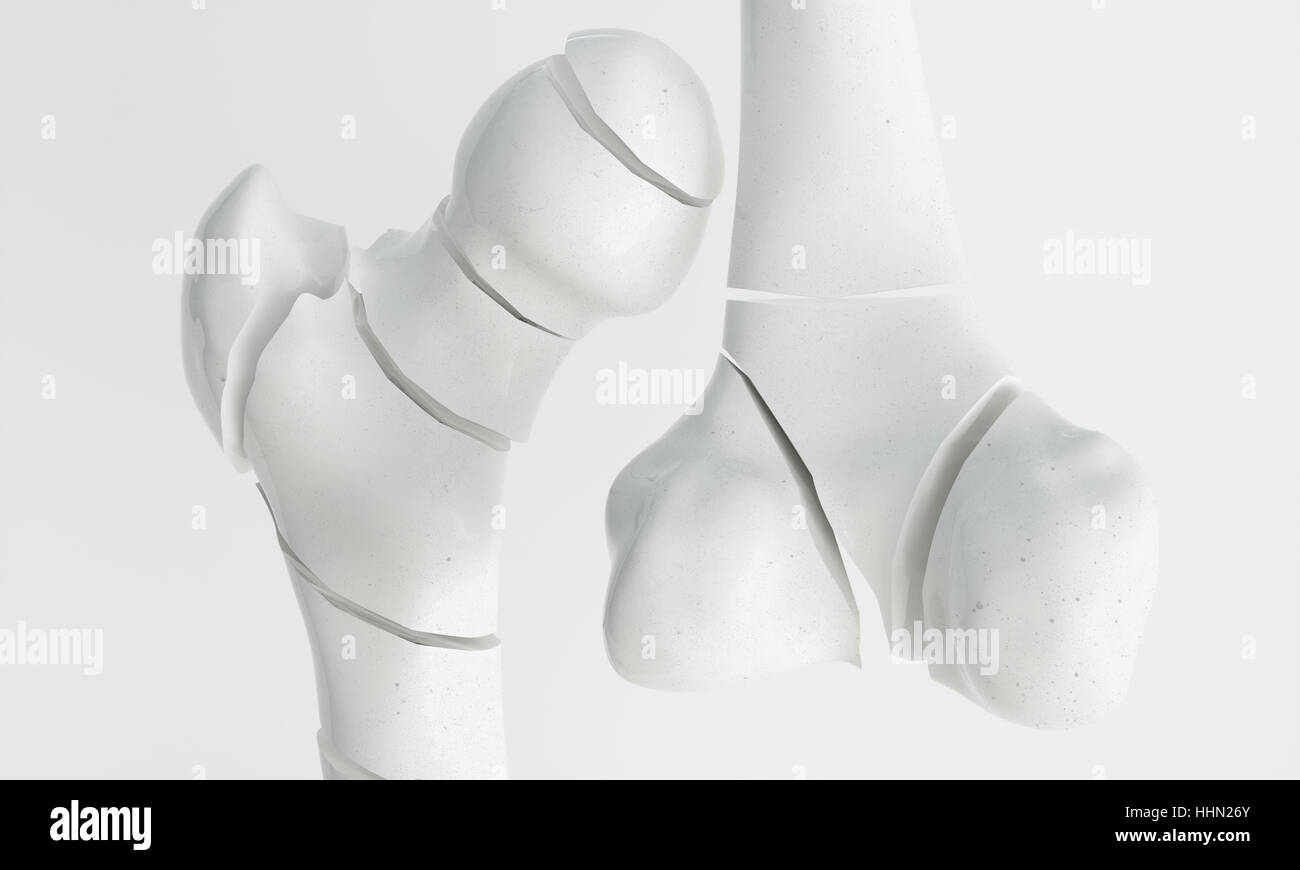 Fracture of the femur - breakpoints - 3D Rendering Stock Photo - Alamy
