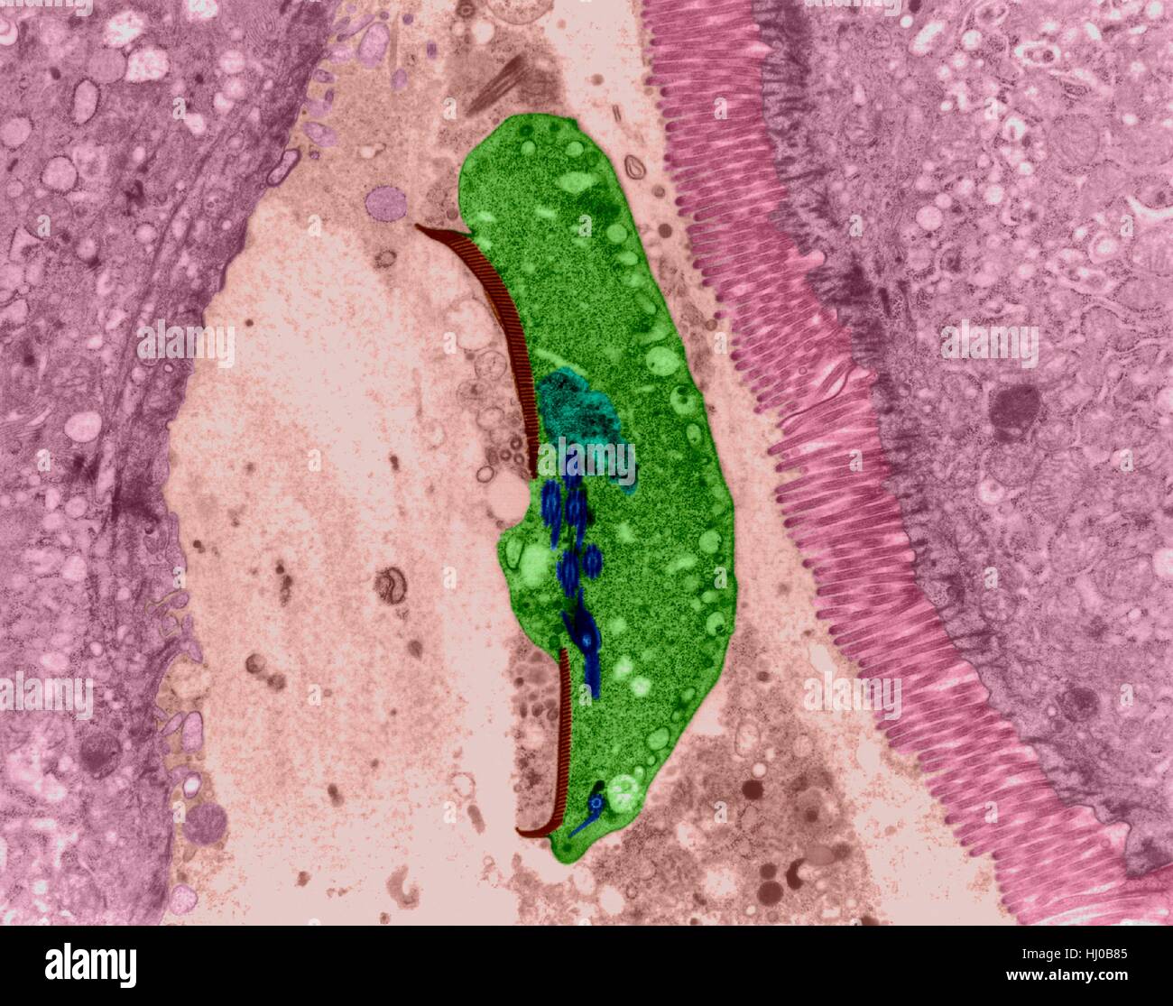 Protozoan infection (giardiasis) in human intestinal lumen (Giardia sp ...