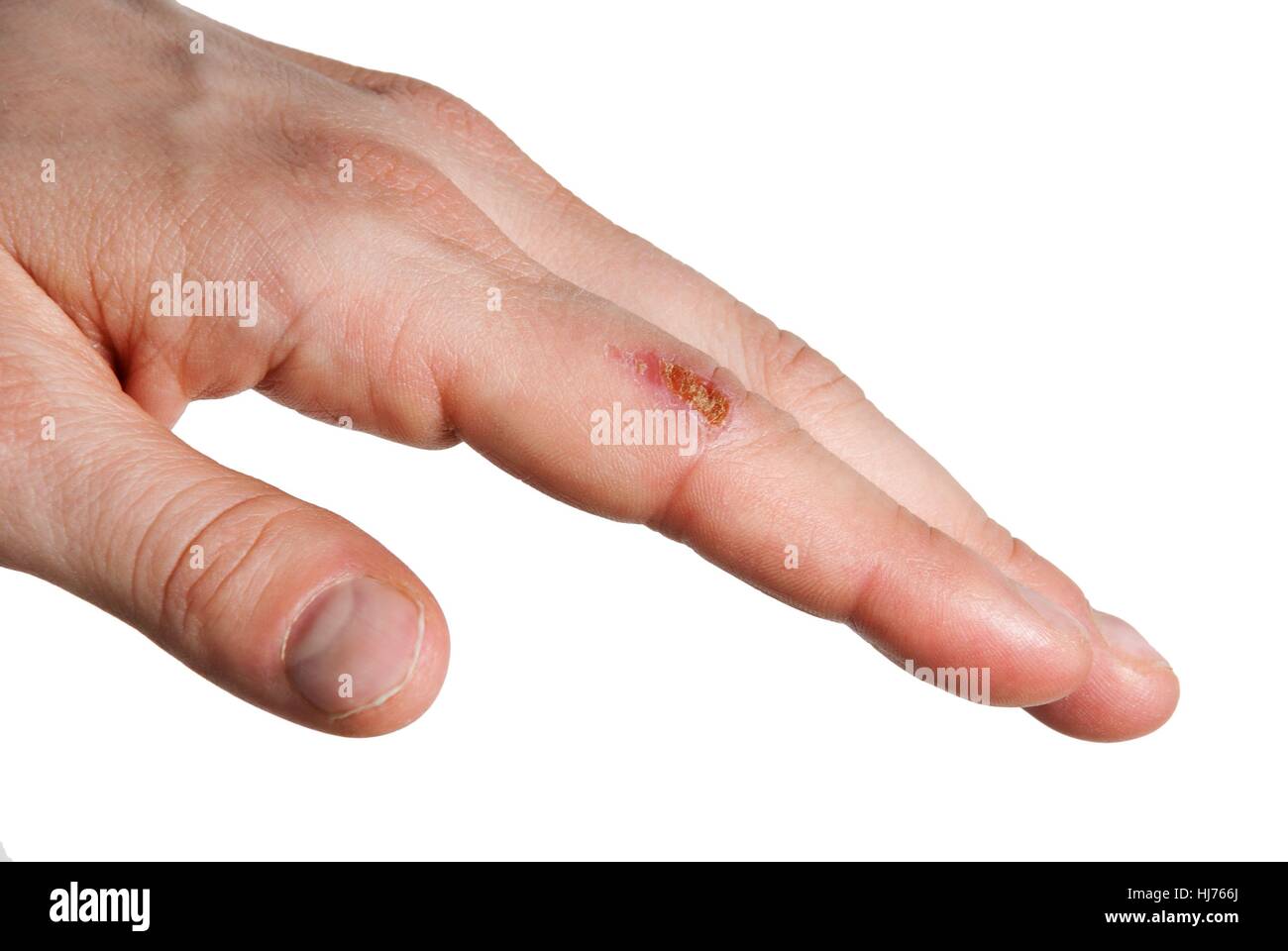 Small wound hi-res stock photography and images - Alamy