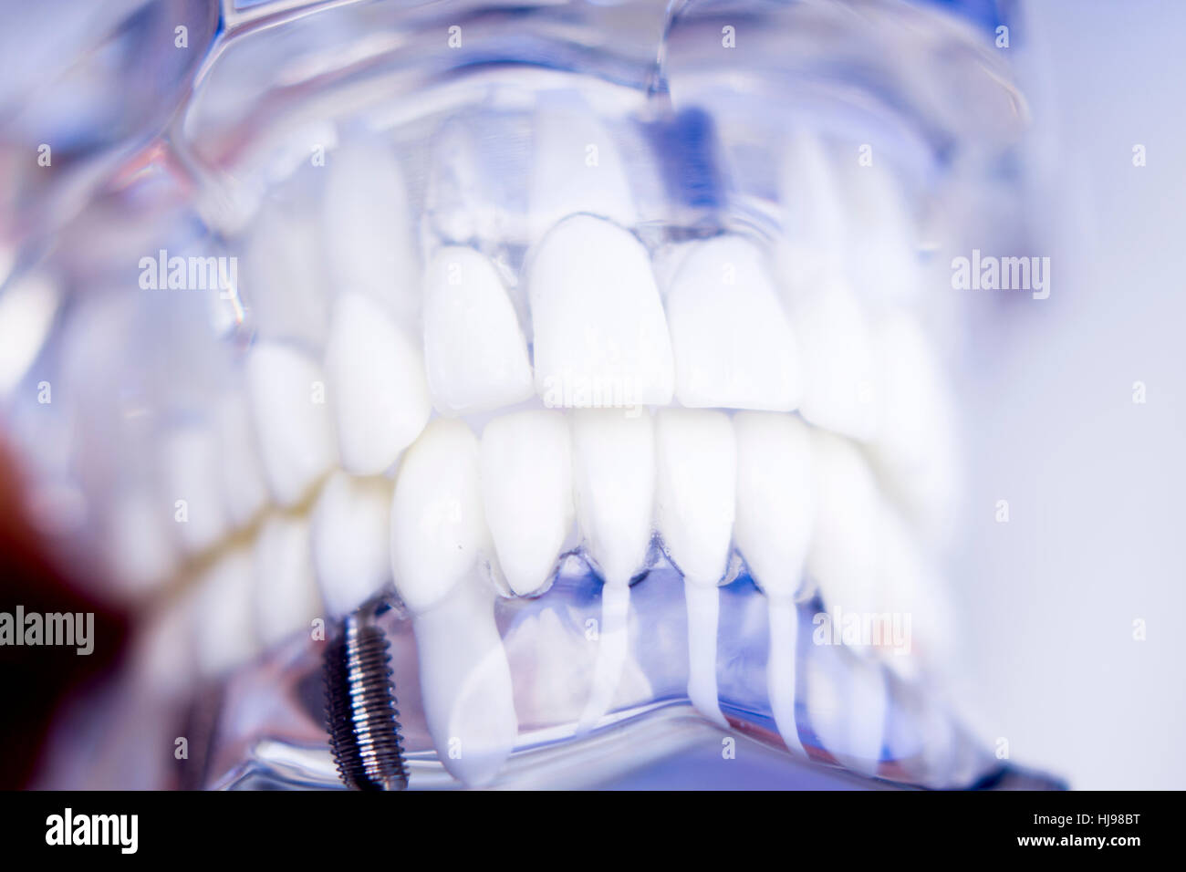 Dentists tooth plastic model with screw implant for teaching, learning ...