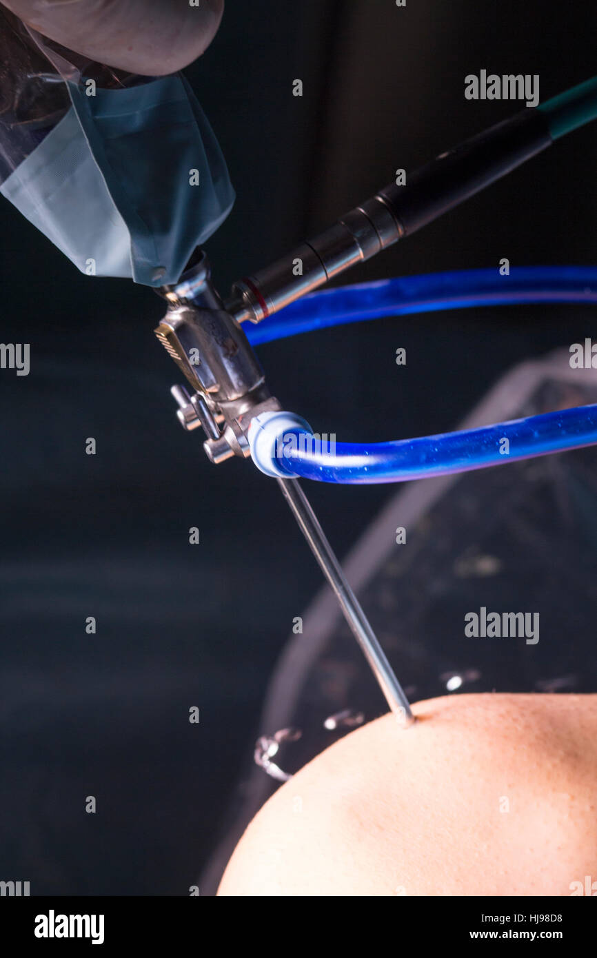 Surgical operation knee arthroscopy micro surgery in hospital operating ...