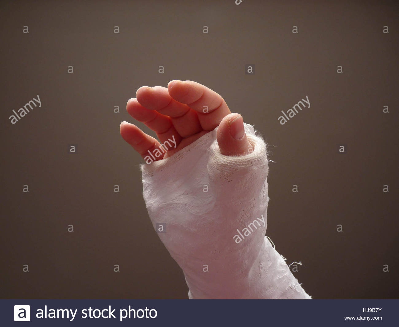 Open Fracture Arm High Resolution Stock Photography and Images - Alamy