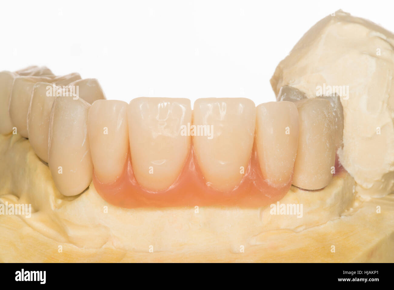 isolated, teeth, bit, dentist, tooth, crown, tooth space, caries ...