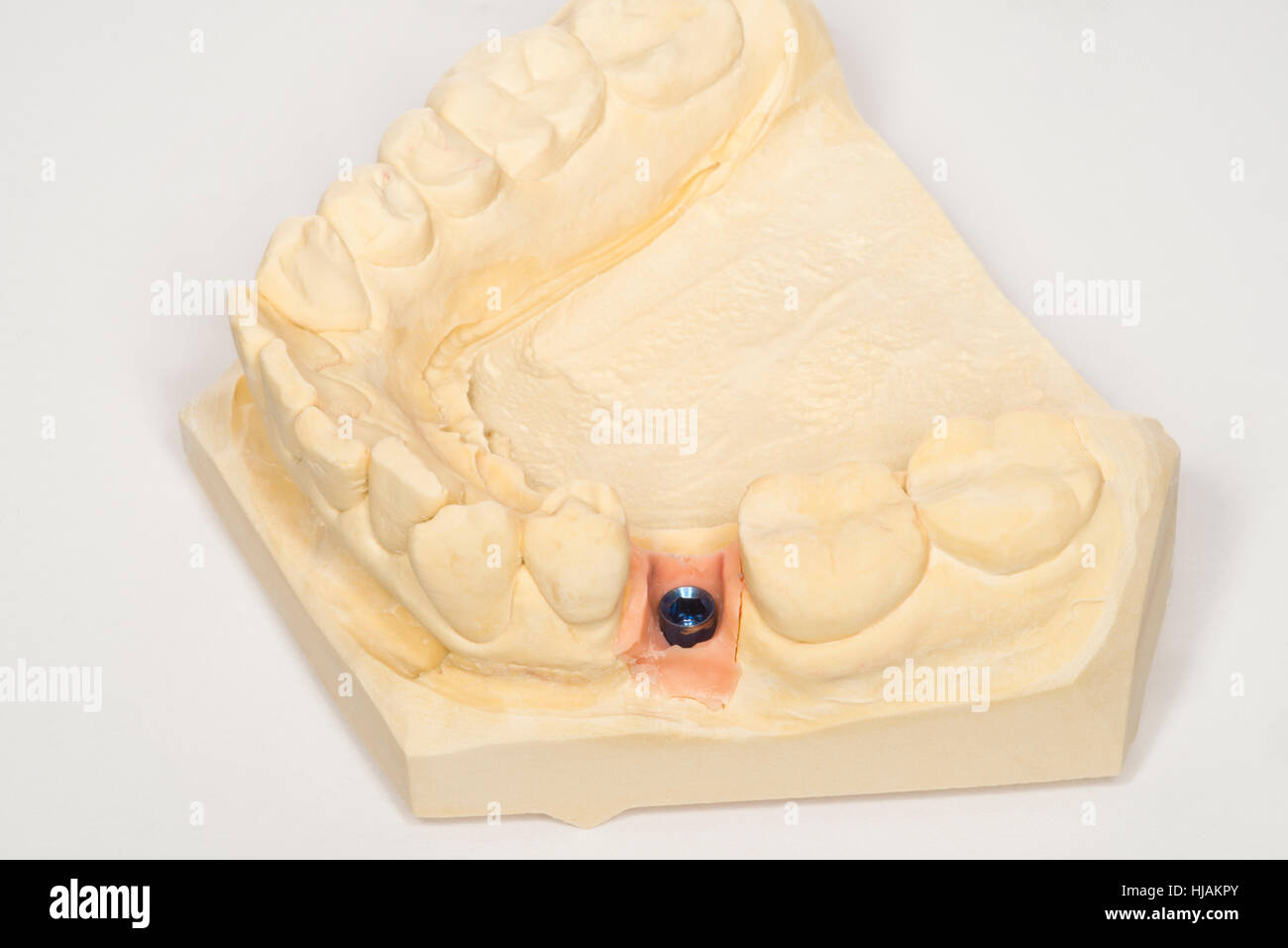 isolated, teeth, bit, dentist, tooth, crown, tooth space, caries ...