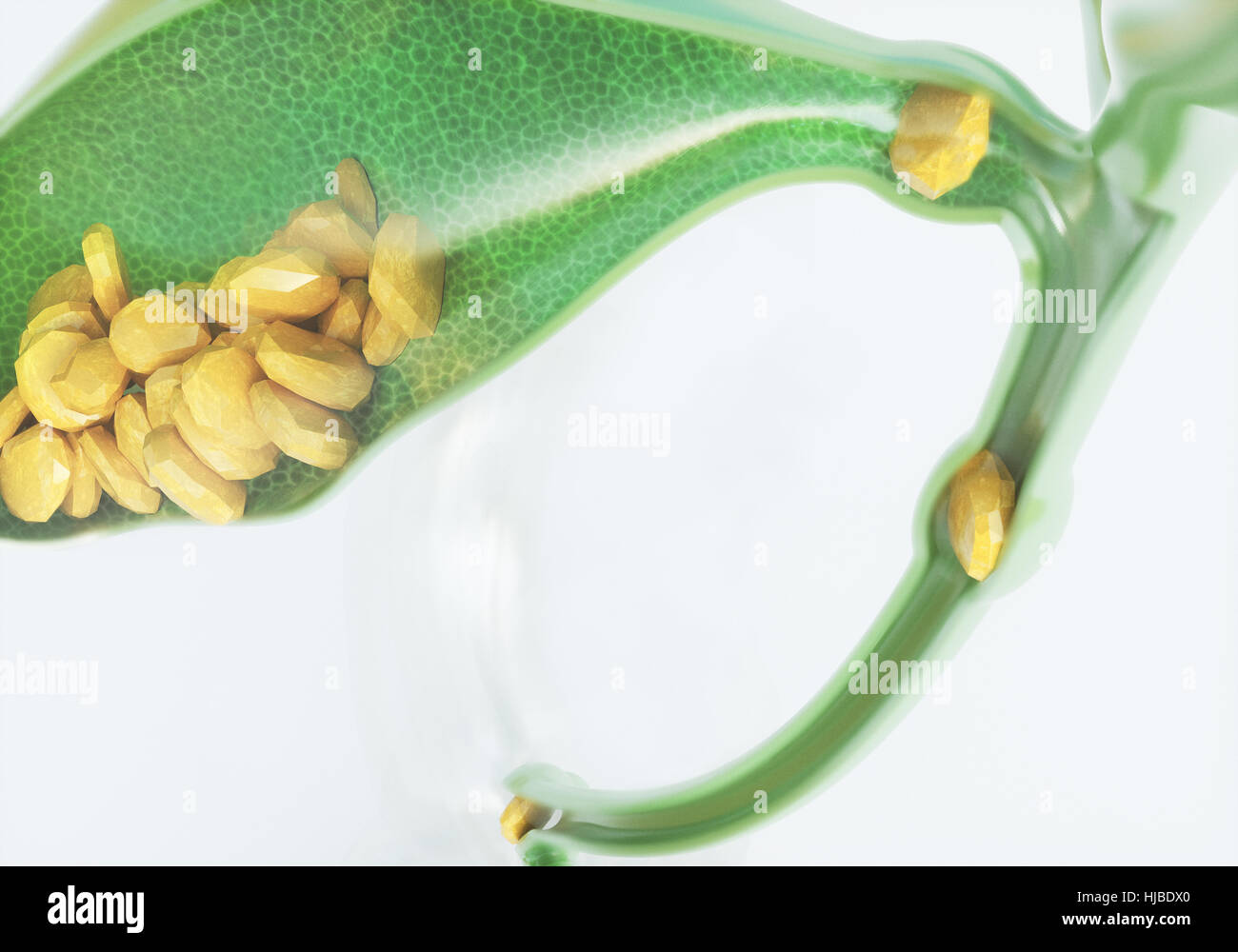 Gallstones hi-res stock photography and images - Alamy