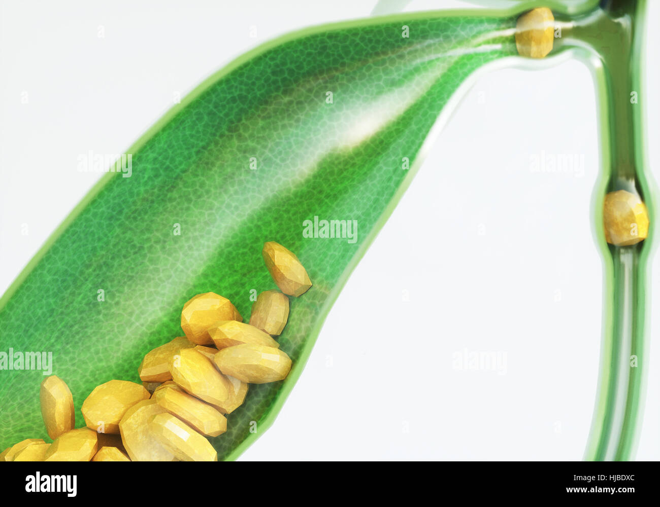 Gallstones hi-res stock photography and images - Alamy
