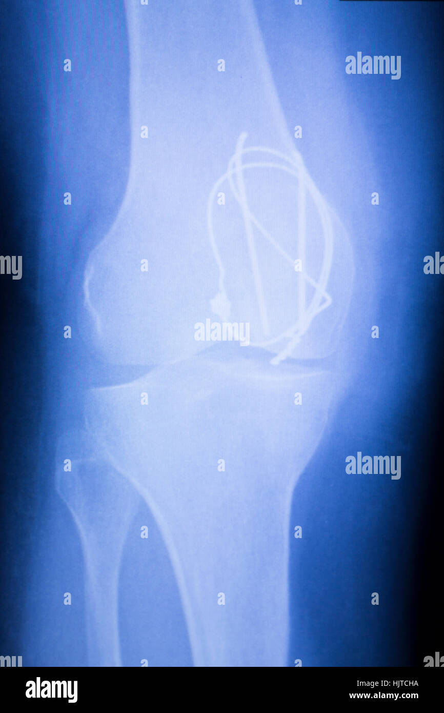 Knee joint implant wire xray showing in medical orthpodedic ...