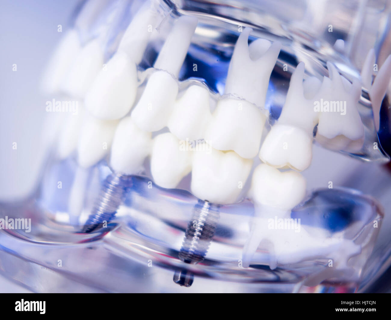 Dentists tooth plastic model with screw implant for teaching, learning ...
