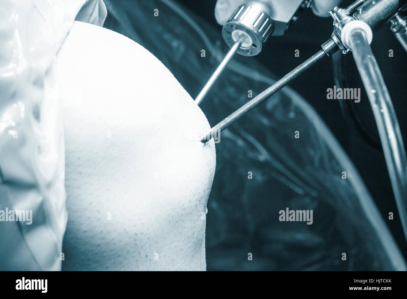 Surgical operation for knee arthroscopy micro surgery in hospital ...