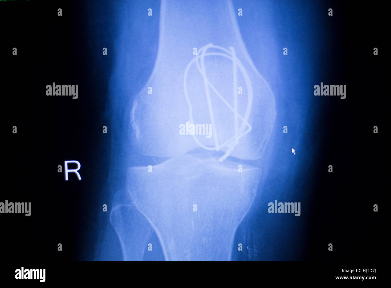 Knee joint implant wire xray showing in medical orthpodedic ...