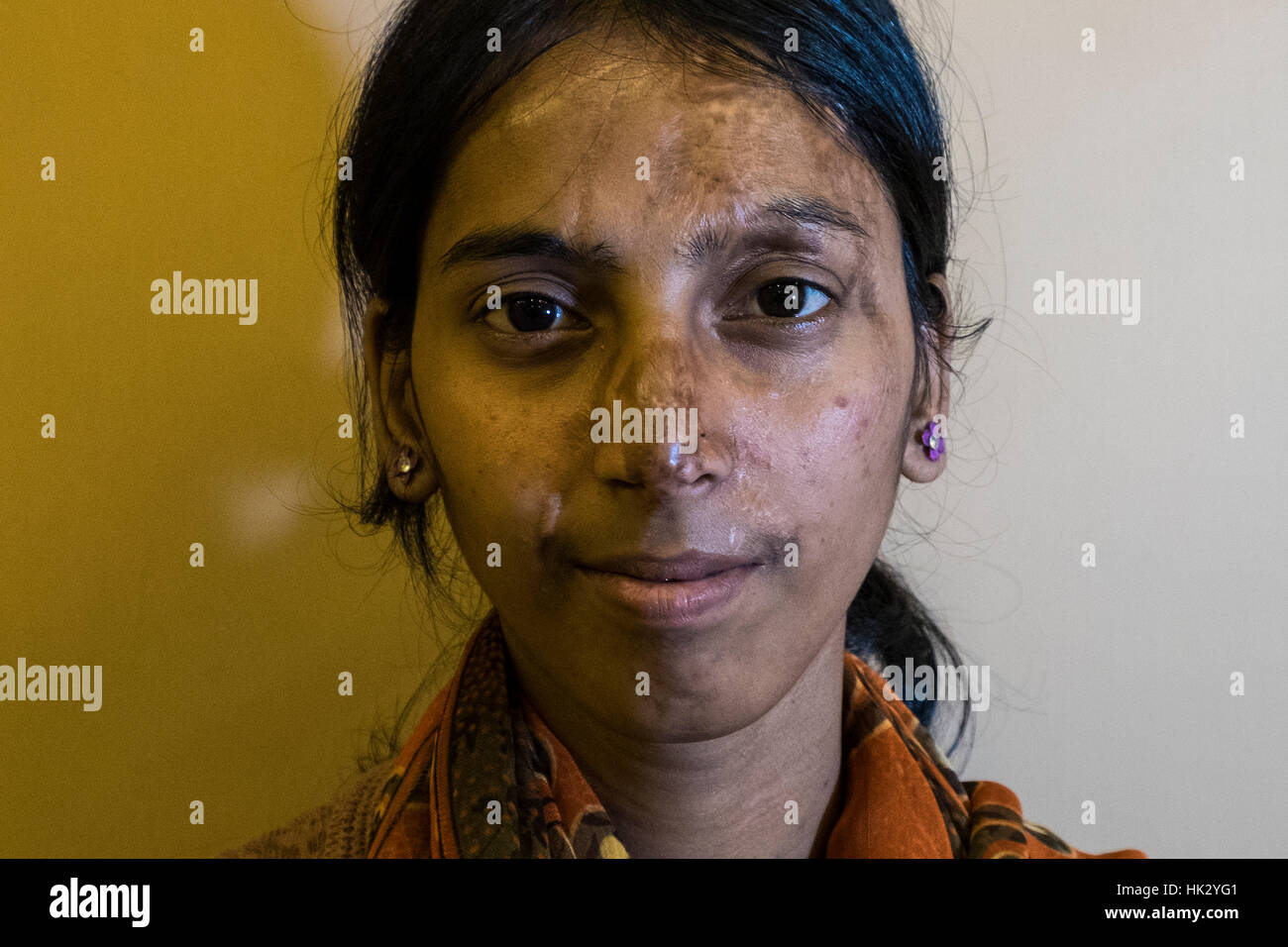 India kolkata women victims acid hi-res stock photography and images ...