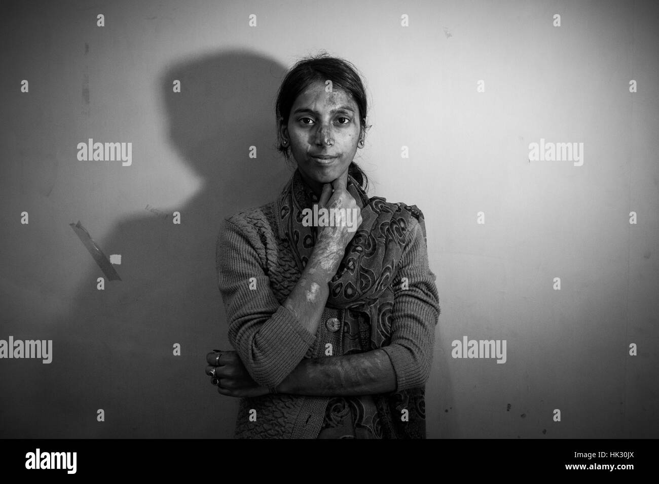India, Kolkata, Women victims acid attack, portrait Stock Photo - Alamy