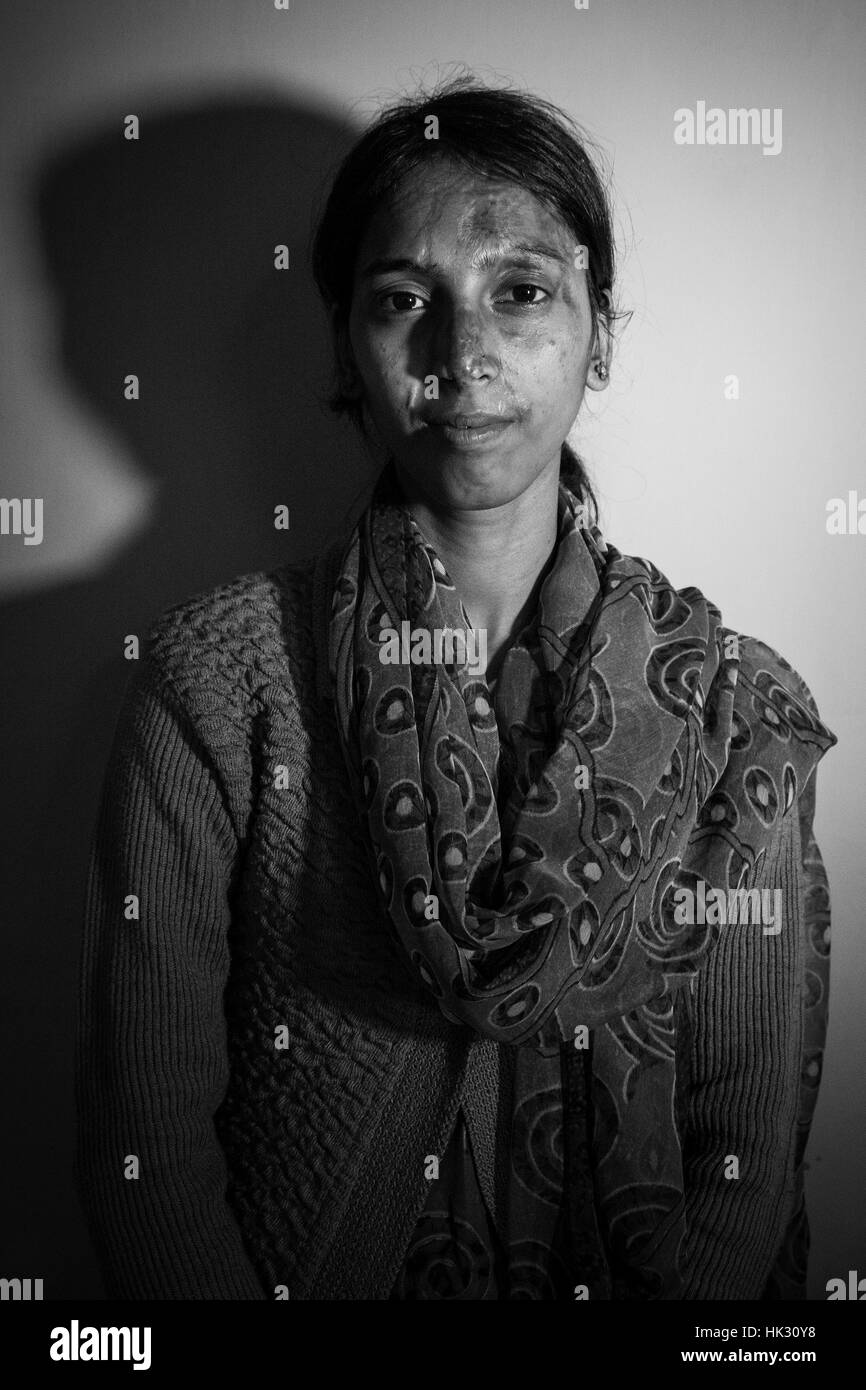 India, Kolkata, Women victims acid attack, portrait Stock Photo - Alamy