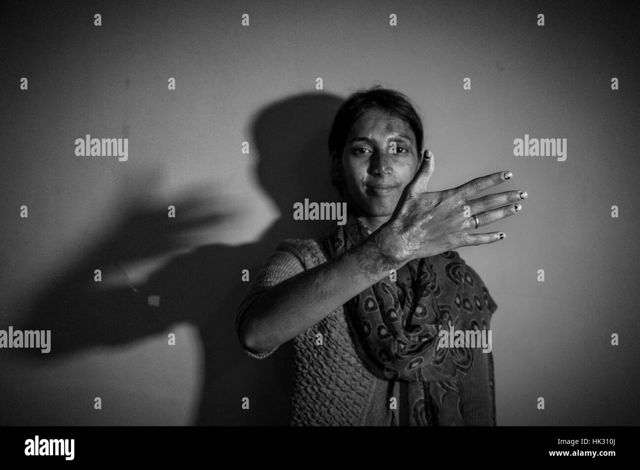 India, Kolkata, Women victims acid attack, portrait Stock Photo - Alamy