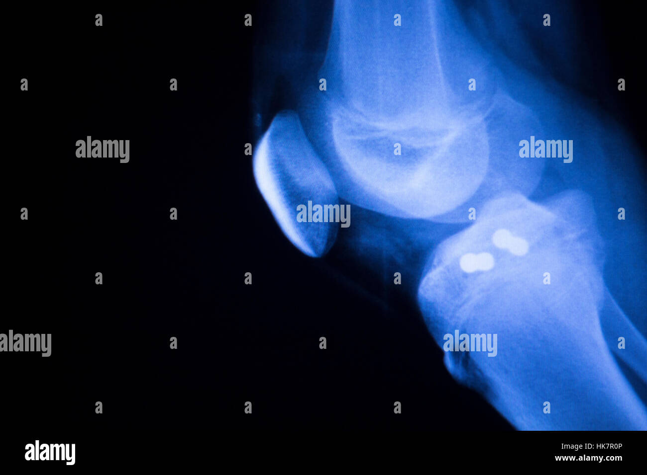 Artificial knee xray hi-res stock photography and images - Alamy
