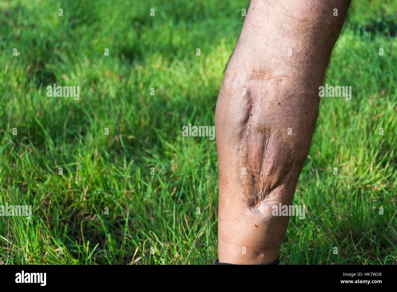 Old scar of leg injury, from car or motorbike accident, deep tissue ...