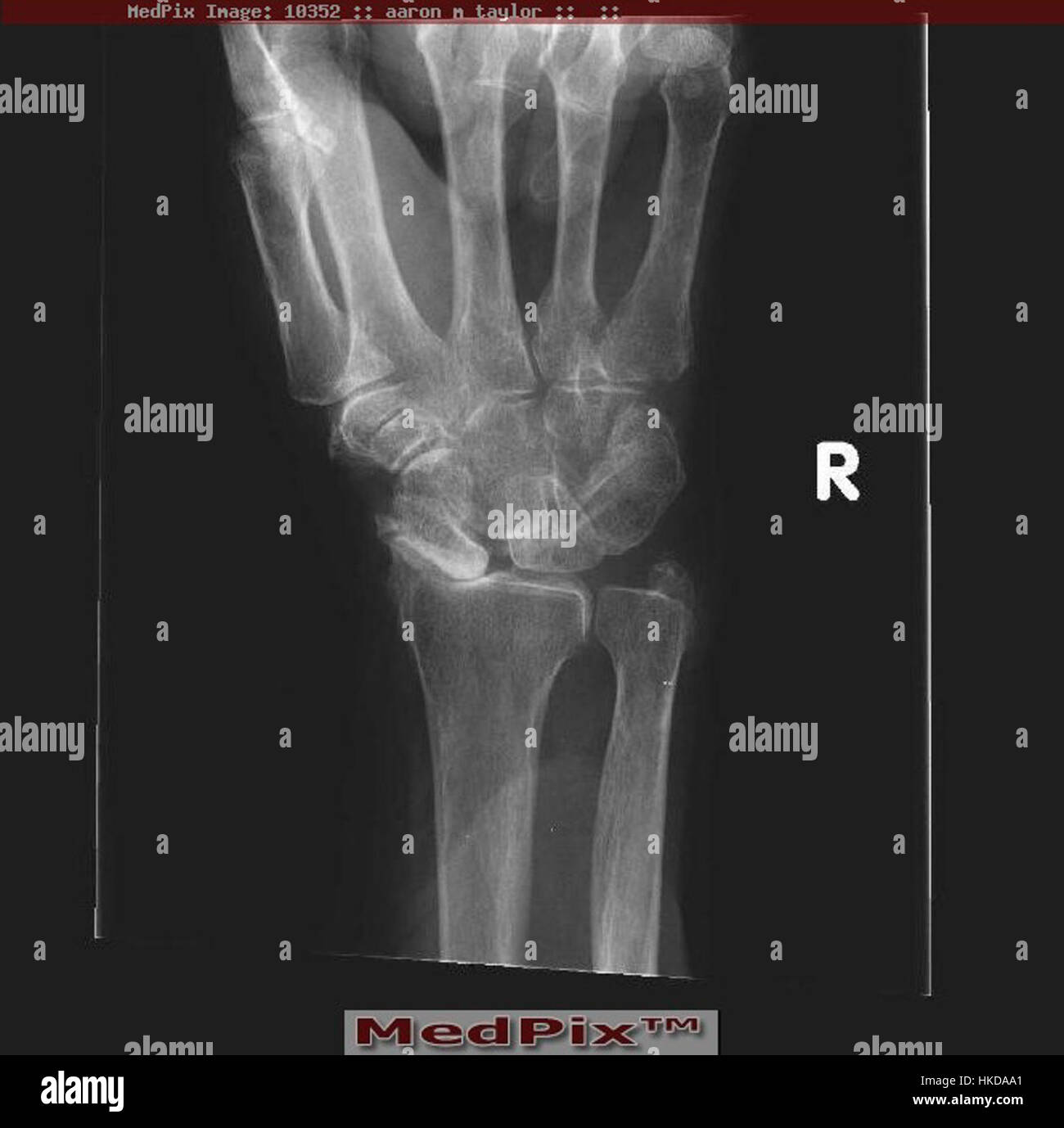 Scapholunate dissociation and SLAC (Scaphoid-Lunate Advanced Collapse ...