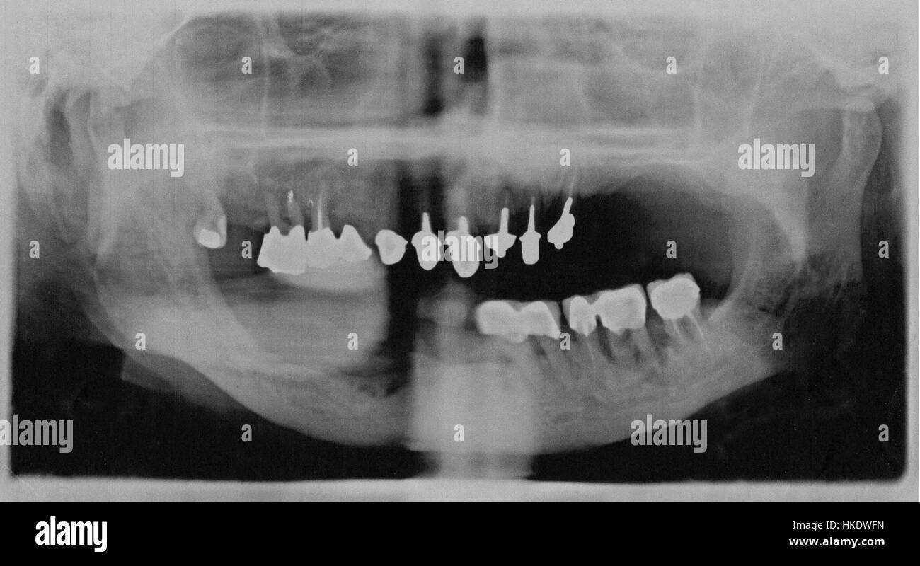 X ray tooth hi-res stock photography and images - Alamy