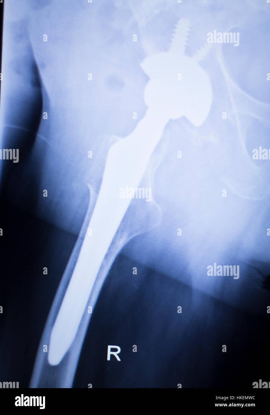 Hip Ball And Socket High Resolution Stock Photography and Images - Alamy