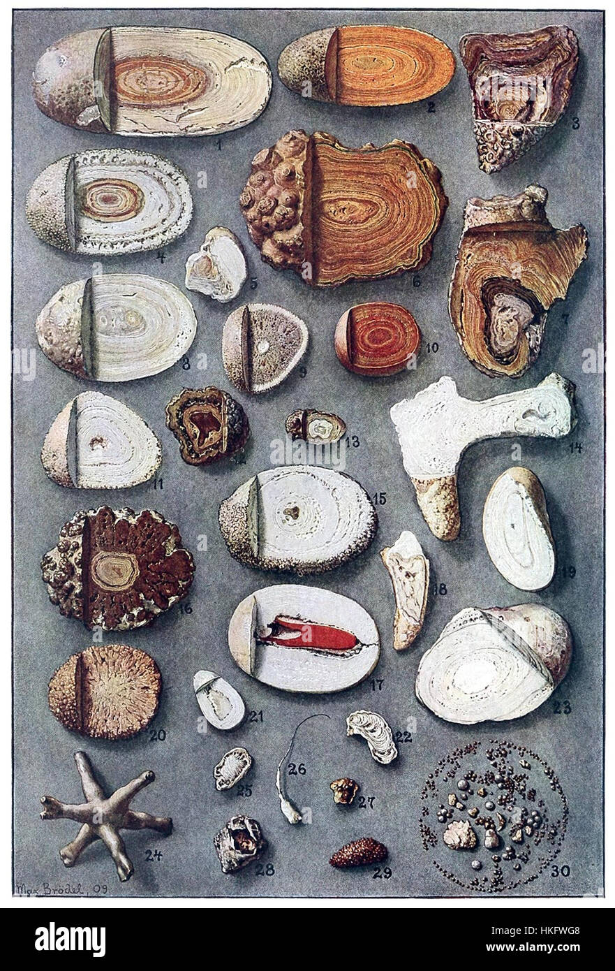An informative depiction of kidney and bladder stones, illustrating ...